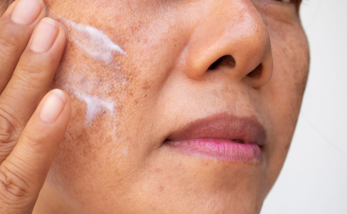 Manchas Solares En La Piel Cómo Tratarlas Y Prevenir Su Aparición